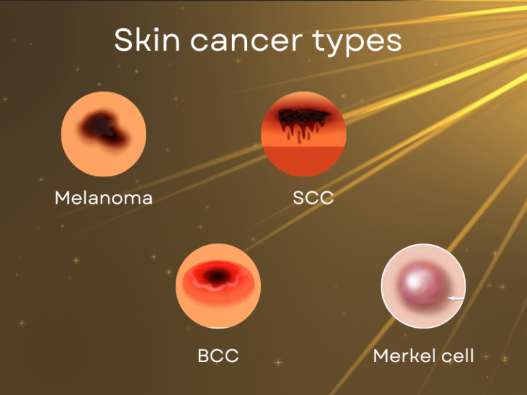 skin cancer types, Treatments and more about skin cancer rash