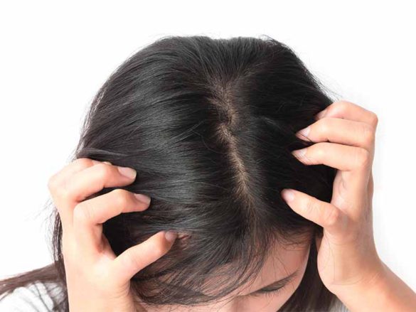 Common scalp conditions & treatments - RemoteDerm
