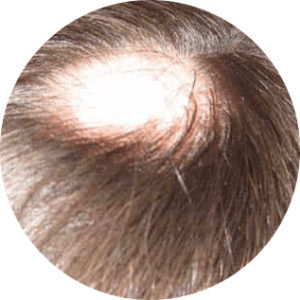 Common scalp conditions & treatments - RemoteDerm
