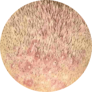 Common scalp conditions & treatments - RemoteDerm