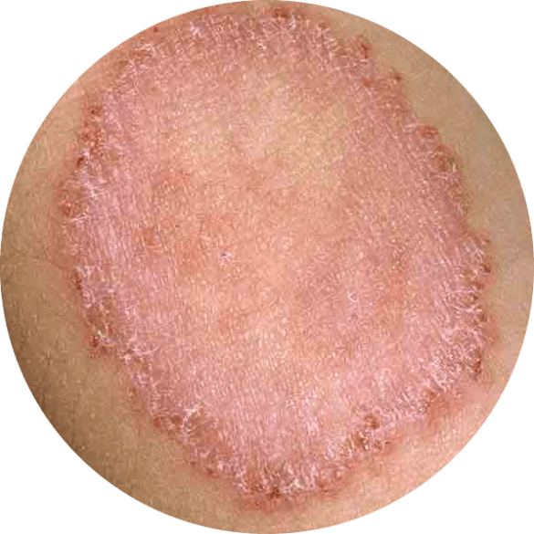 Ringworm rashes | causes and treatments - Remotederm