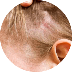 Ringworm rashes | causes and treatments - Remotederm