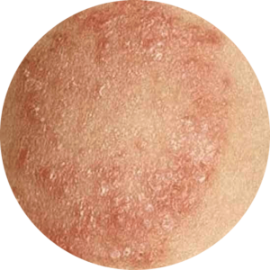 Ringworm rashes | causes and treatments - Remotederm