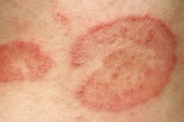 Types Of Dandruff Causes Symptoms Solutions - RemoteDerm