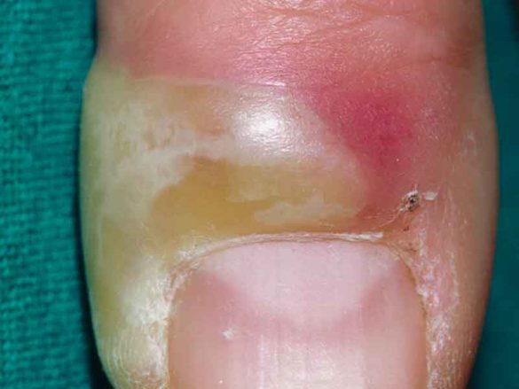 Nail Diseases Chart: Picture, Sign and Treatment