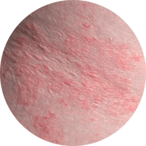 Ringworm rashes | causes and treatments - Remotederm