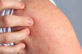 Understanding Weeping Eczema - RemoteDerm