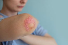Understanding Weeping Eczema - RemoteDerm