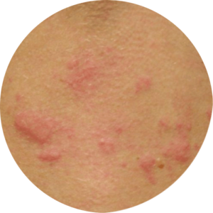 Everything about hives and its causes - Remotederm