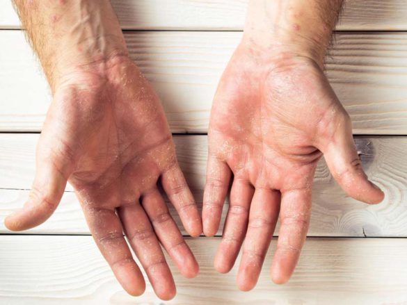 Psoriasis vs. Eczema: How to Tell Them Apart - Remotederm