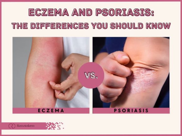 Psoriasis vs. Eczema: How to Tell Them Apart - Remotederm