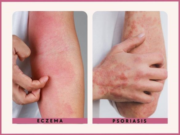 Psoriasis vs. Eczema: How to Tell Them Apart - Remotederm