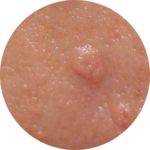 Sebaceous Hyperplasia cause, Symptoms,Treatments - Remotederm