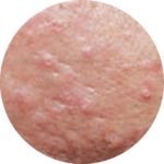 Sebaceous Hyperplasia cause, Symptoms,Treatments - Remotederm