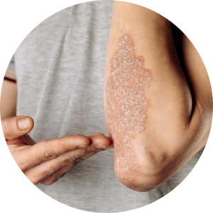 Psoriasis vs. Eczema: How to Tell Them Apart - Remotederm