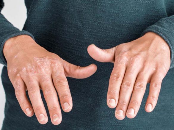Psoriasis vs. Eczema: How to Tell Them Apart - Remotederm