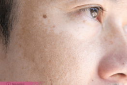 What causes filiform warts - RemoteDerm