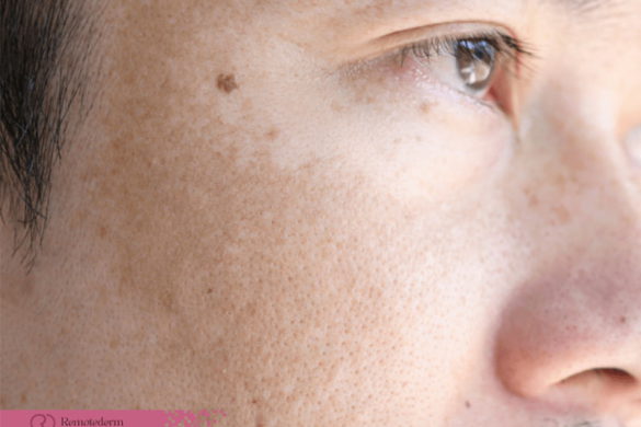 Melasma Treatment & Skincare Tips | RemoteDerm