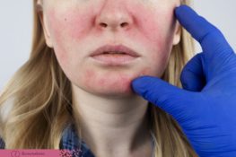 Understanding Weeping Eczema - RemoteDerm