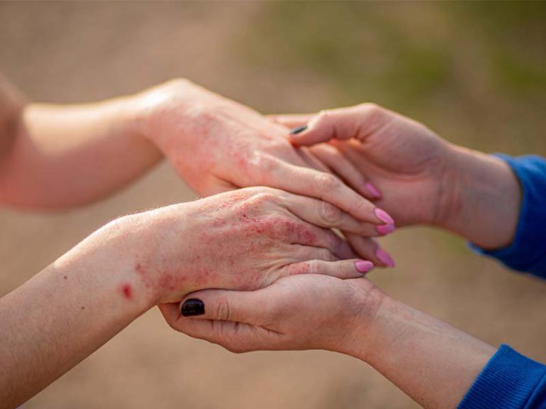 Skin Rash Types, Causes, Treatment, Prevention - Remotederm