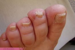 Understanding the Nail Matrix - RemoteDerm