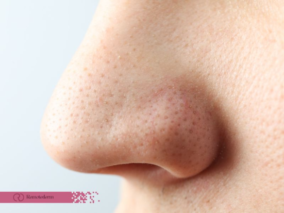 Comedonal Acne, What, Causes and treatmeent - RemoteDerm