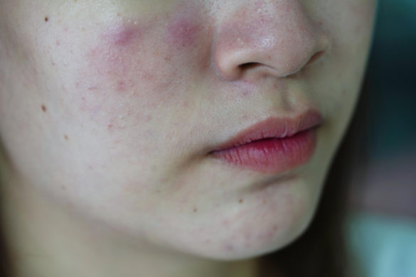 Comedonal Acne, What, Causes and treatmeent - RemoteDerm