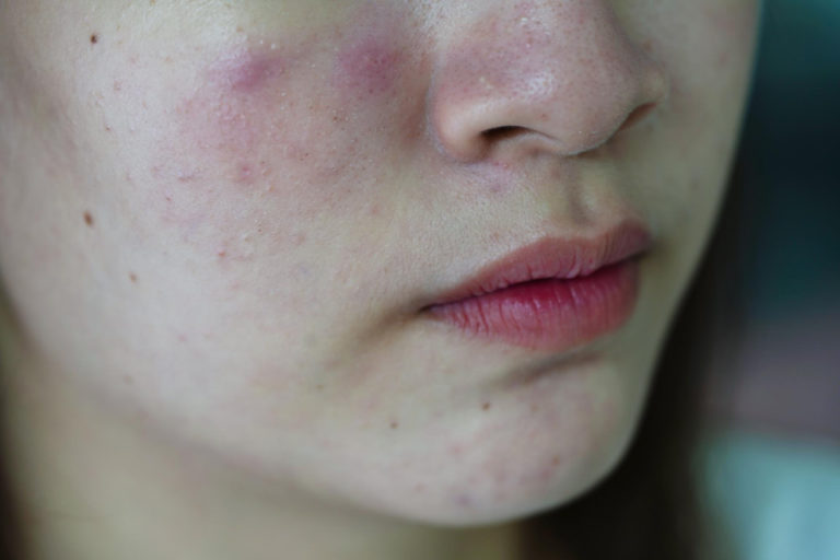 Comedonal Acne, What, Causes and treatmeent - RemoteDerm