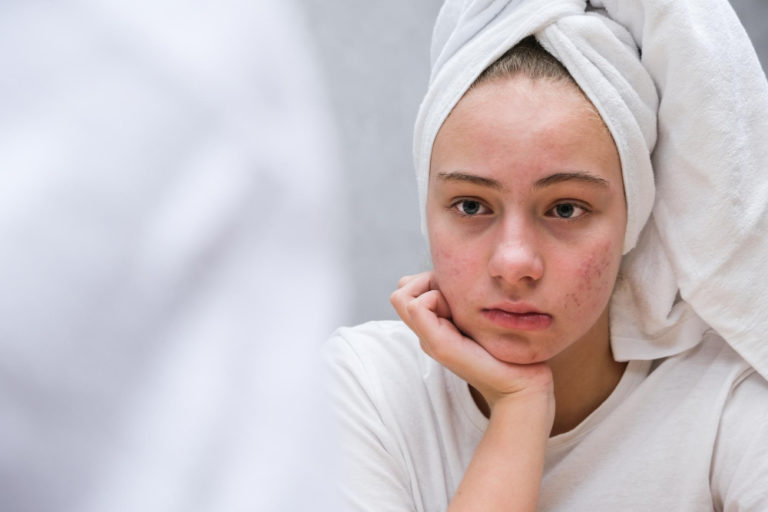 Comedonal Acne, What, Causes and treatmeent - RemoteDerm