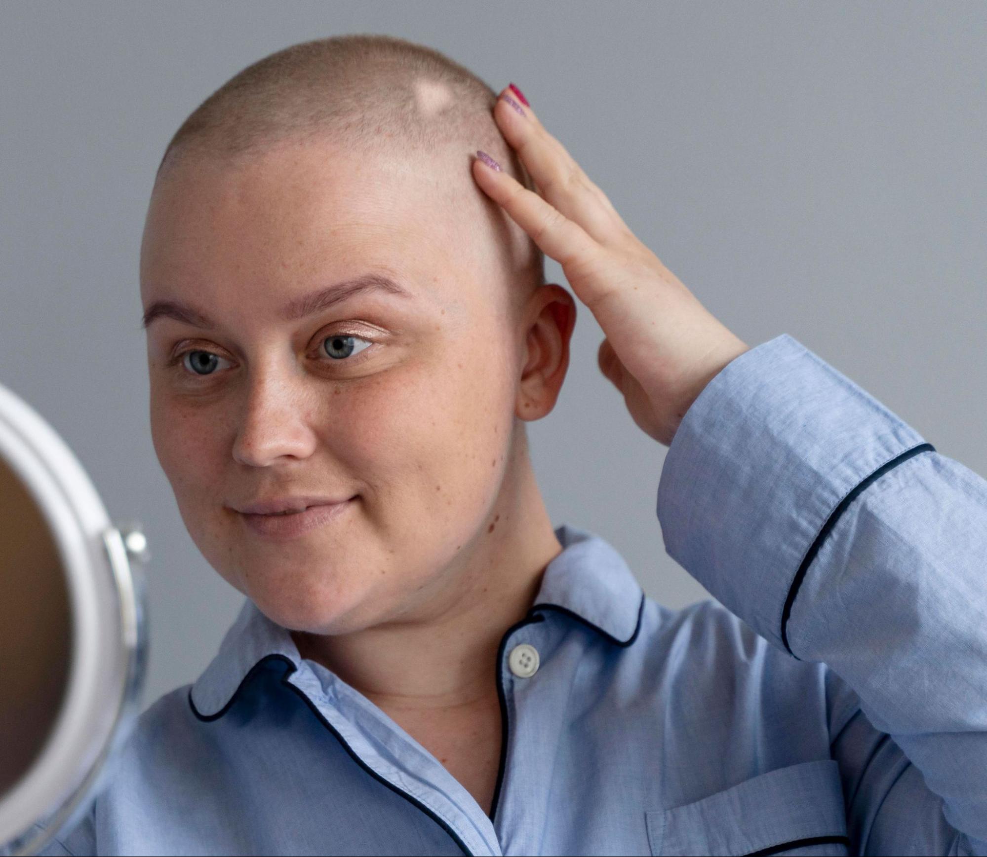 Patch Baldness: Living with Alopecia Areata- Remotederm