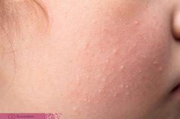 Understanding Weeping Eczema - RemoteDerm