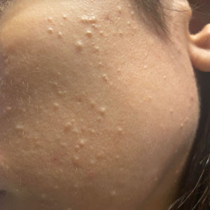 Milia Bumps Ruining Your Skin? Try These Effective treatment