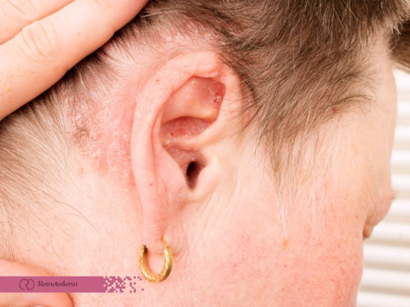 Scalp Psoriasis: Symptoms, Causes & Treatments- RemoteDerm