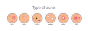 Acne vs. Pimples: What's the Real Difference? - RemoteDerm Blog