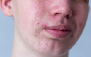 Acne vs. Pimples: What's the Real Difference? - RemoteDerm Blog