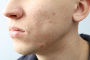 Acne vs. Pimples: What's the Real Difference? - RemoteDerm Blog