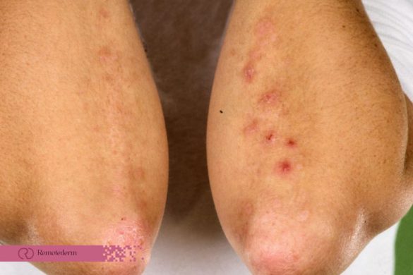 Dermatitis herpetiformis vs eczema -RemoteDerm