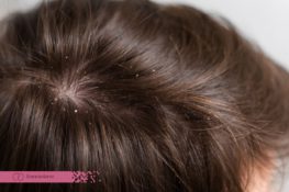 Understanding Every Type of Hairline - RemoteDerm