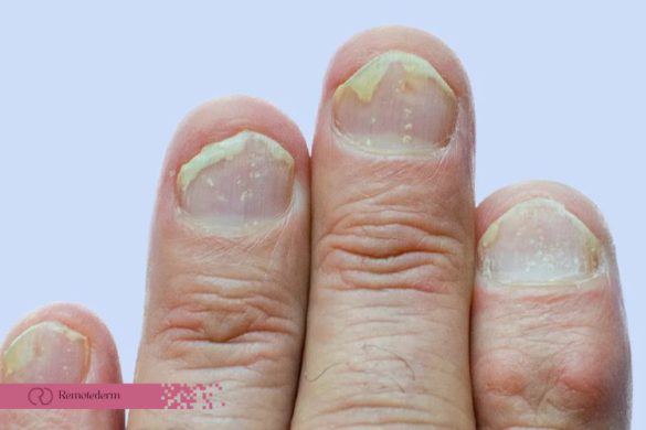 Nail Diseases Chart: Picture, Sign and Treatment