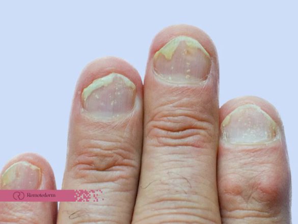 Nail Psoriasis Pictures Symptoms and Treatments - RemoteDerm