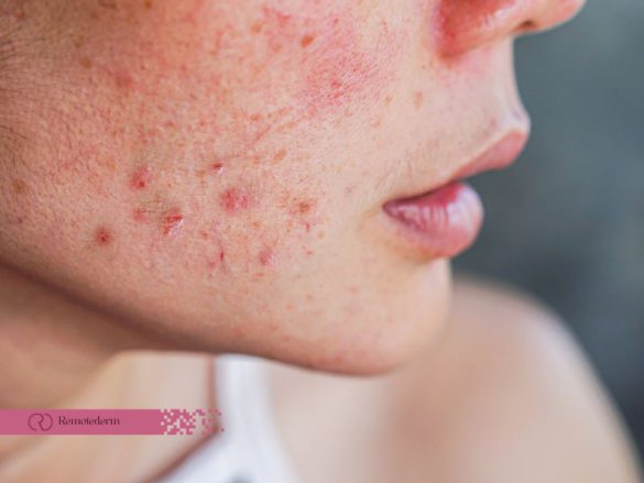 Nodular Acne Treatment: Comprehensive Guide - RemoteDerm