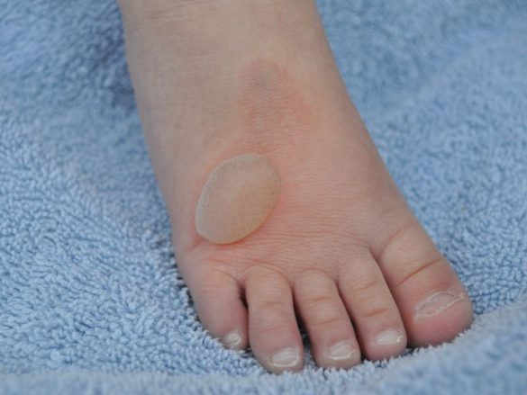 Blisters: Causes, Symptoms, and More - RemoteDerm