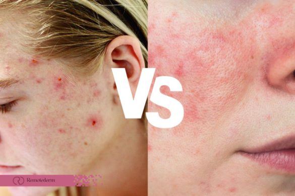 Acne vs. Pimples: What's the Real Difference? - RemoteDerm Blog
