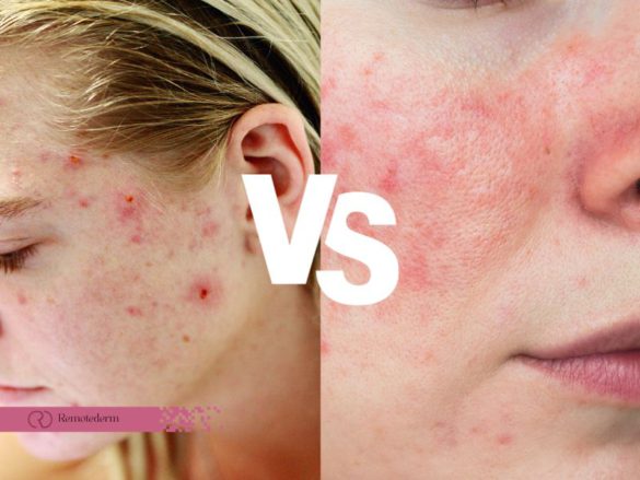 Difference between acne vs rosacea - RemoteDerm