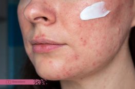 Facial Plethora: Causes and Treatments - RemoteDerm