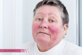 Facial Plethora: Causes and Treatments - RemoteDerm