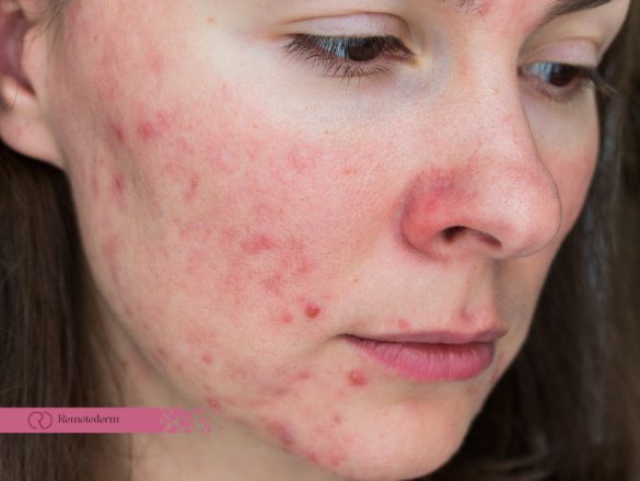 Papulopustular Rosacea Triggers & Solutions -RemoteDerm