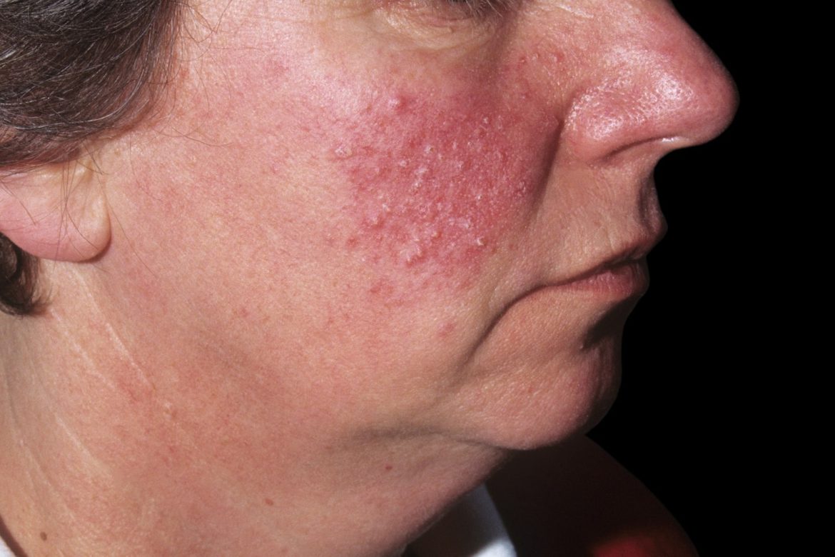 Papulopustular Rosacea Triggers & Solutions -RemoteDerm