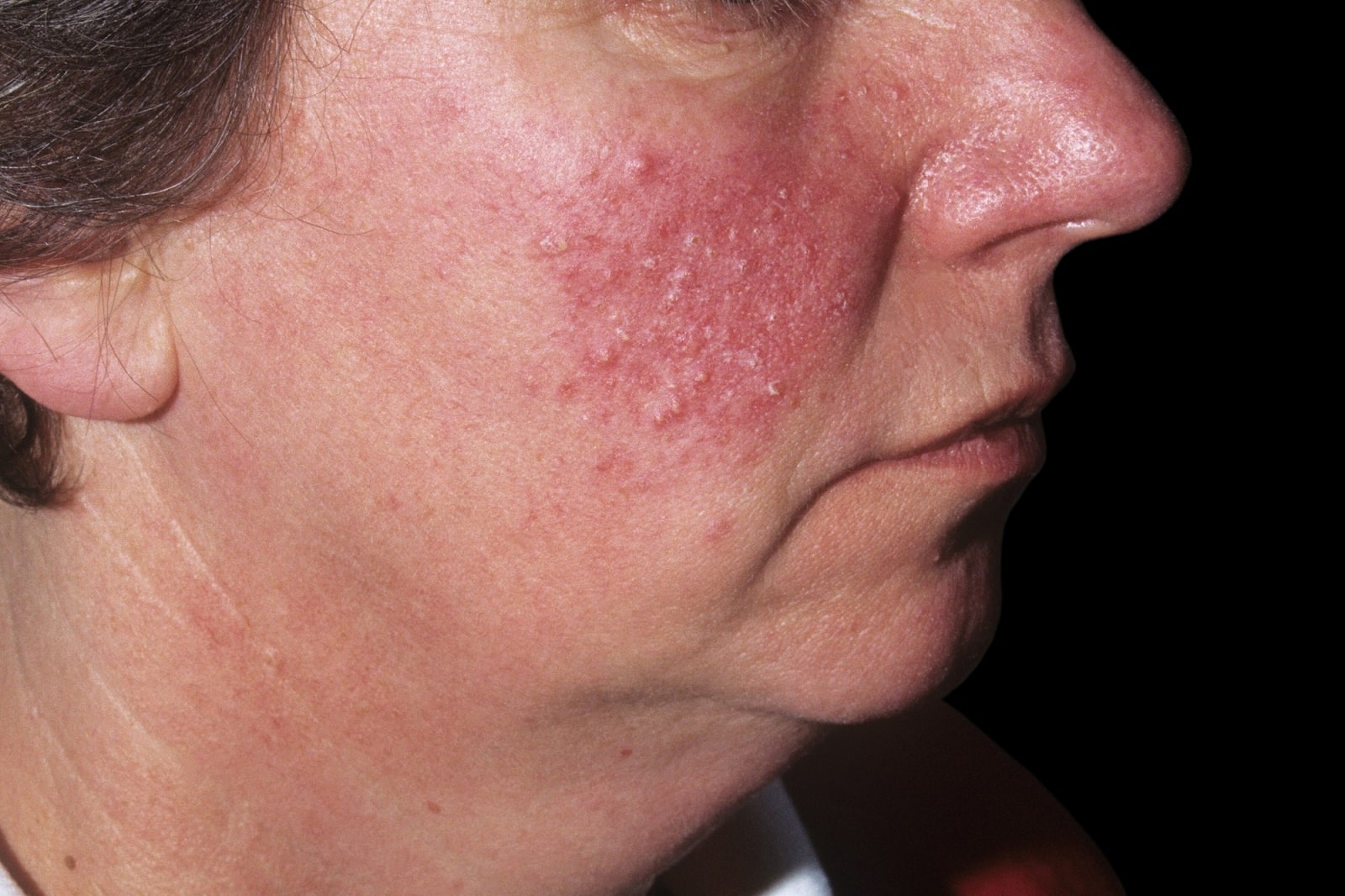 Papulopustular Rosacea Triggers & Solutions -RemoteDerm