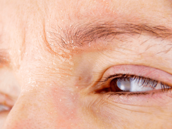 Eyebrow Dandruff Guide: Causes & Treatments - RemoteDerm